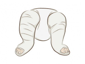 Pé torto congênito: o que é e como corrigir? - Hospital AACD